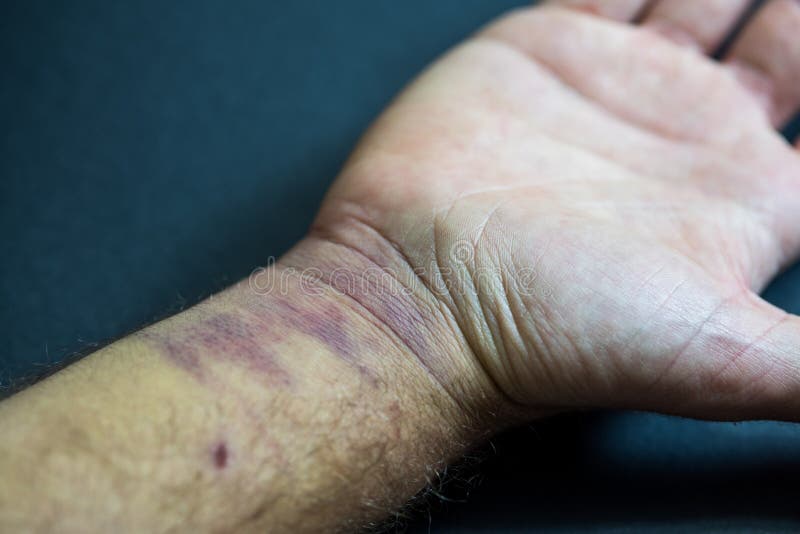 Man`s Arm with Bruises on His Hand and Wrist Stock Image - Image of ...
