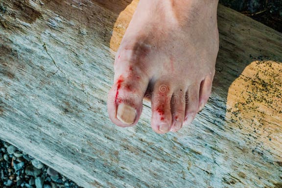 Man& X27;s Bleeding Bare Feet after Being Cut by Sharp Rocks at an ...