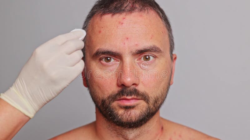 Man S Forehead with Acne, Red Spots, Skin Disease Stock Video - Video ...