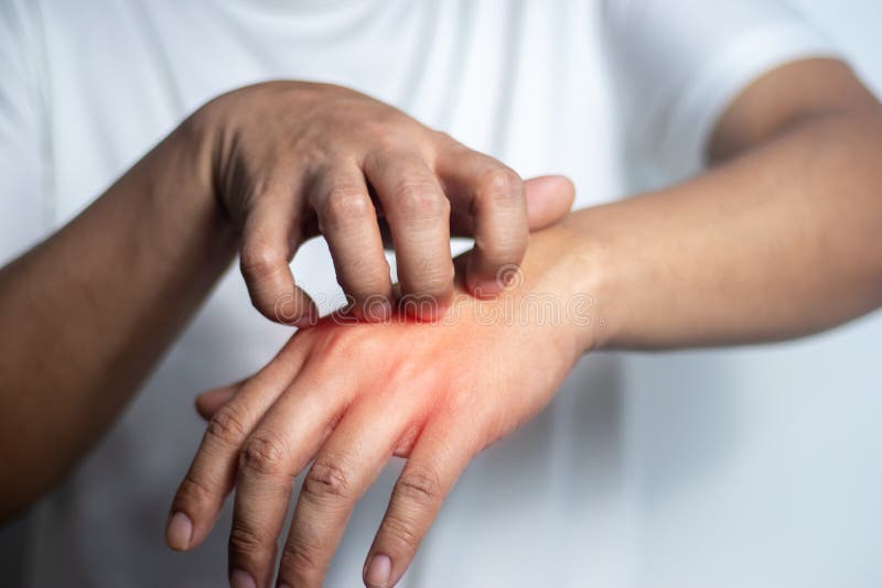 Man Scratching His Hand. Medical Stock Image - Image of atopic, care ...