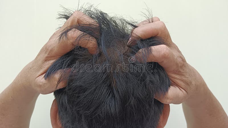 Man Scratching His Head with Dandruff Stock Photo - Image of nose ...