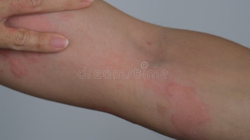 A Man Scratching the Hives Skin on Hand Stock Video - Video of biduran ...