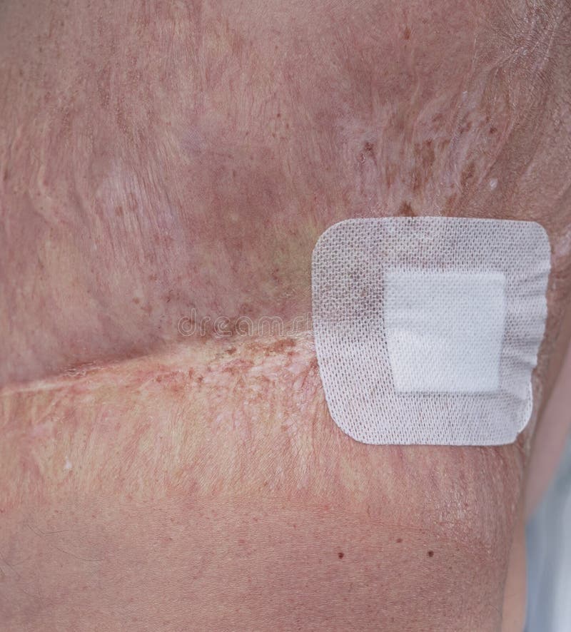 Man with a Severe Burn All Over His Body. Close Up Stock Photo - Image ...