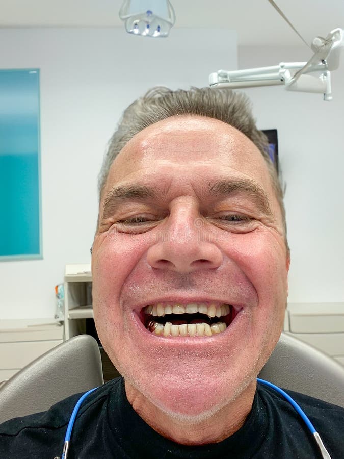 Man Showing His Old Teeth before Getting New Teeth at the Dentist Stock ...