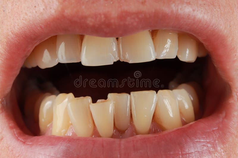 Man Showing His Two Front Incisors Teeth that are Chipped Stock Image ...