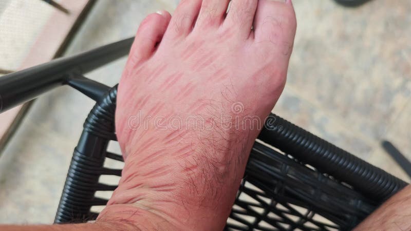 Man Showing Reddened Skin from Wicker Chair Pattern Stock Footage ...