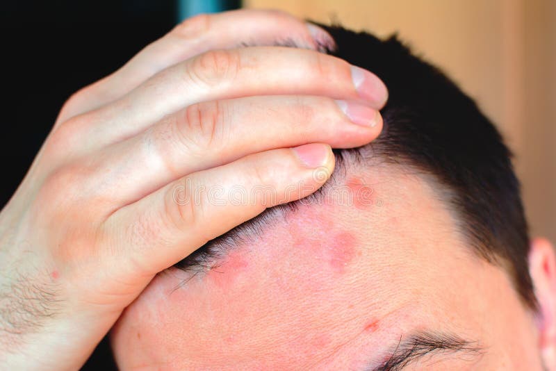 Psoriasis on the Hairline and on the Scalp Stock Photo - Image of close ...