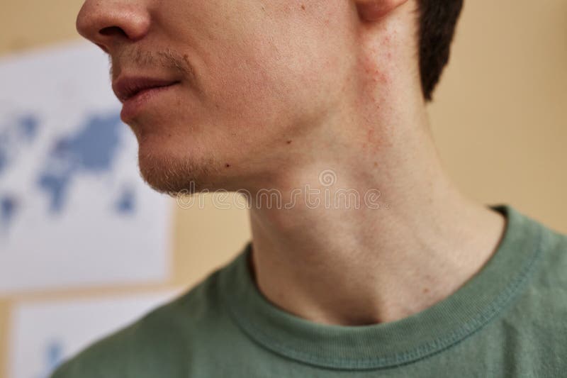 Man with Skin Rash or Psoriasis Spots on Neck Stock Image - Image of ...