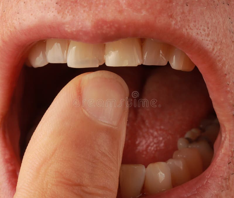 Man with Small Chips on His Two Front Teeth Stock Image - Image of nose ...