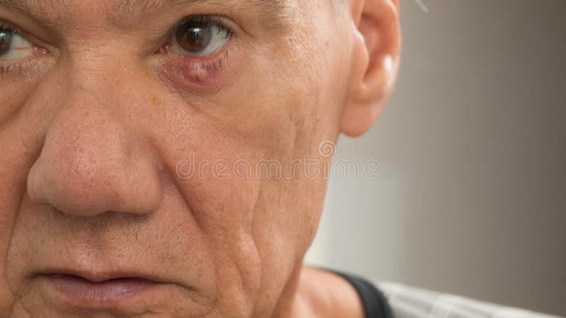Man with stye on eyelid stock photo. Image of bacteria - 213381970