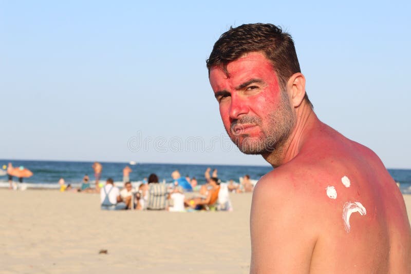 Man Suffering the Consequences of Too Much Uv Light Exposure Stock ...