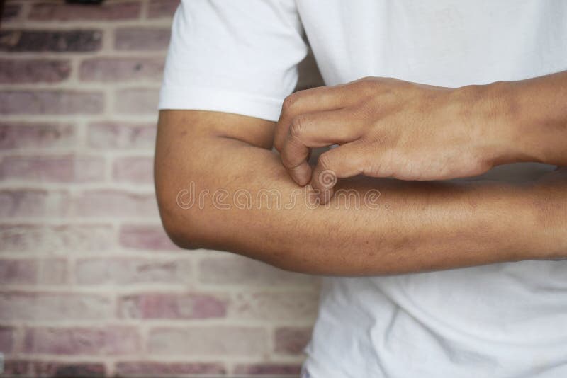 Man Suffering from Itching Skin, Close Up. Stock Image - Image of white ...