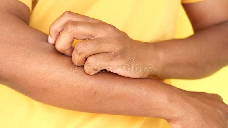 Man Suffering from Itching Skin, Close Up. Stock Footage - Video of ...