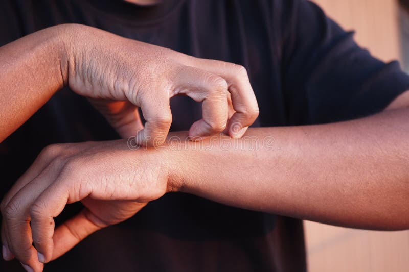Man Suffering from Itching Skin, Close Up. Stock Image - Image of sick ...