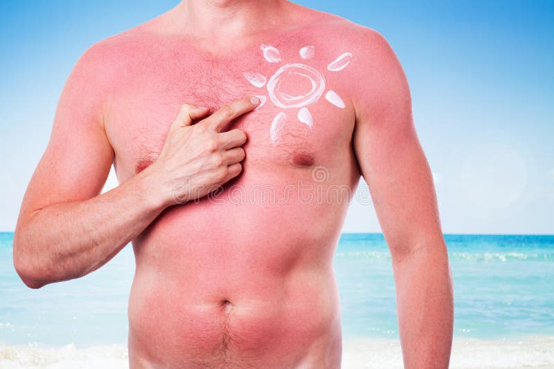 Sunburn Stock Image Image Of Lines Roasted Medical Clipping 818347