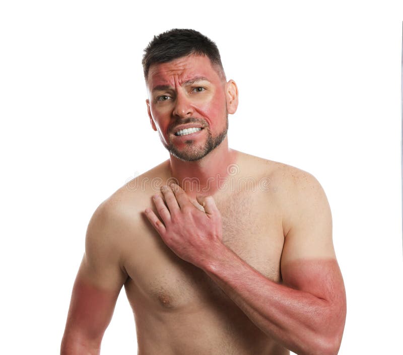 Man With Sunburned Skin On White Background Closeup Stock Image