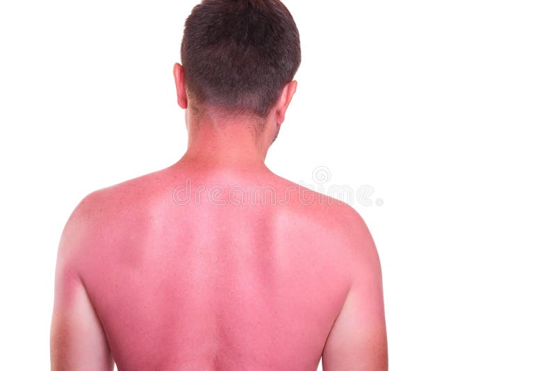 Man with Sunburnt Back on White Background Stock Photo - Image of ...