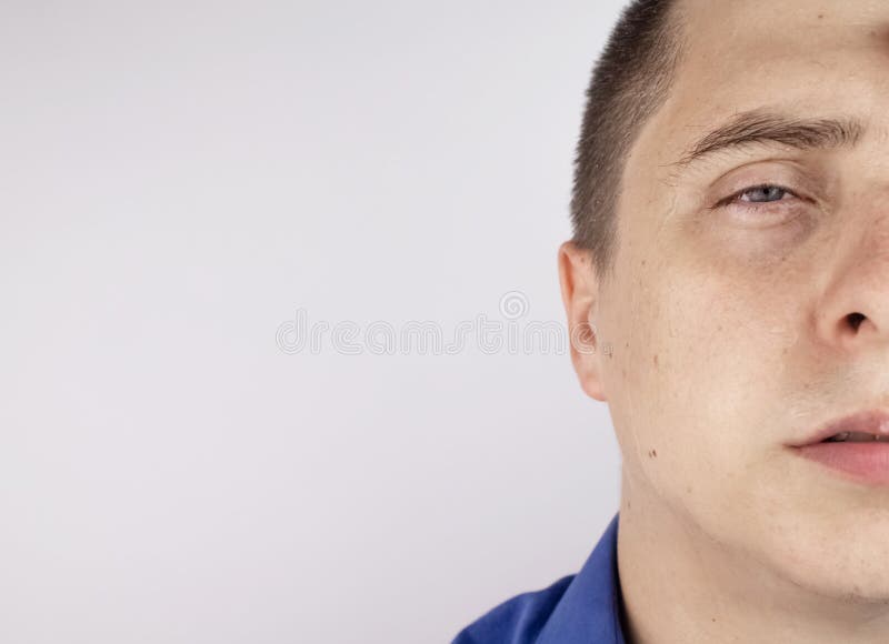 A Man with Sweating on His Face is Looking at the Camera. Sweat Gland ...