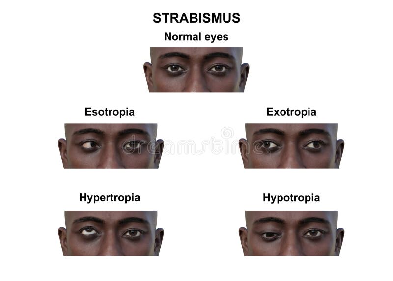 A Man with Various Strabismus Types, 3D Illustration Stock Illustration ...