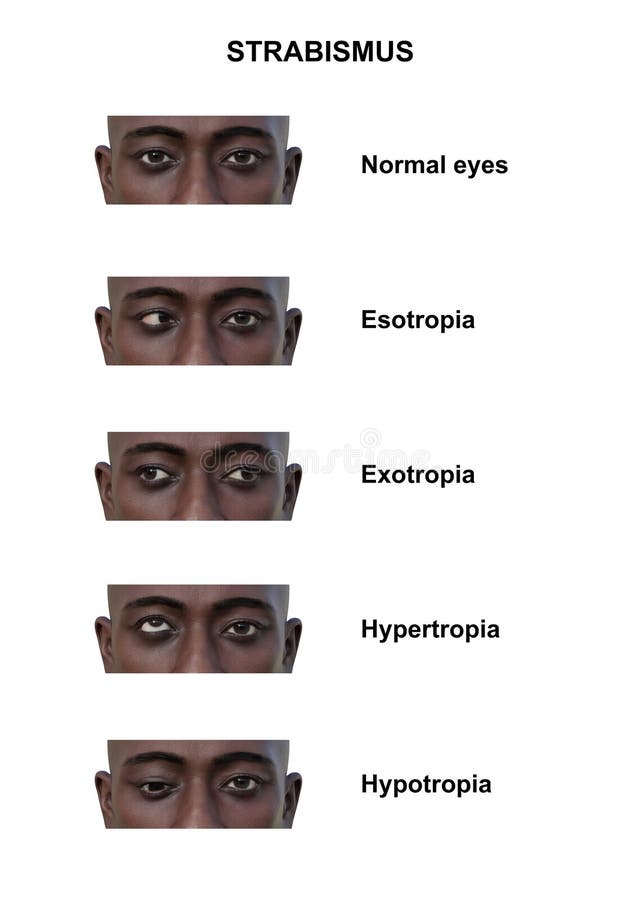A Man with Various Strabismus Types, 3D Illustration Stock Illustration ...