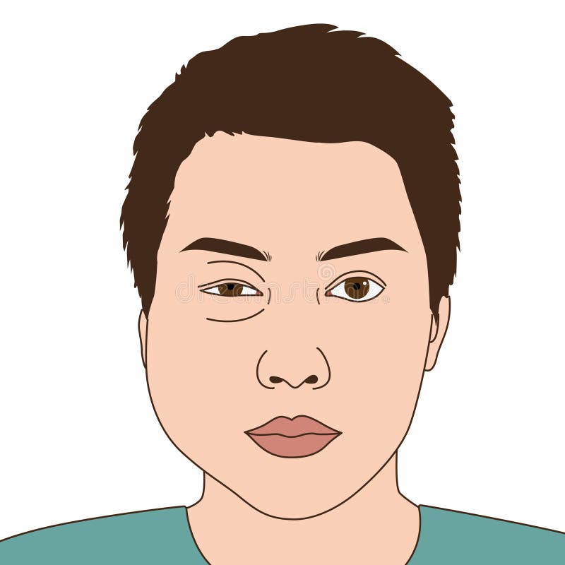 Man Was Swollen Face, Eye, Illustration on White Background Stock ...