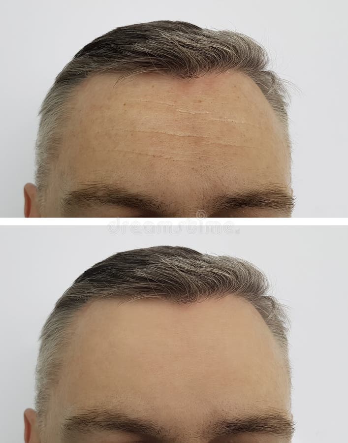 Man Wrinkles on the Forehead before and after Stock Image - Image of ...