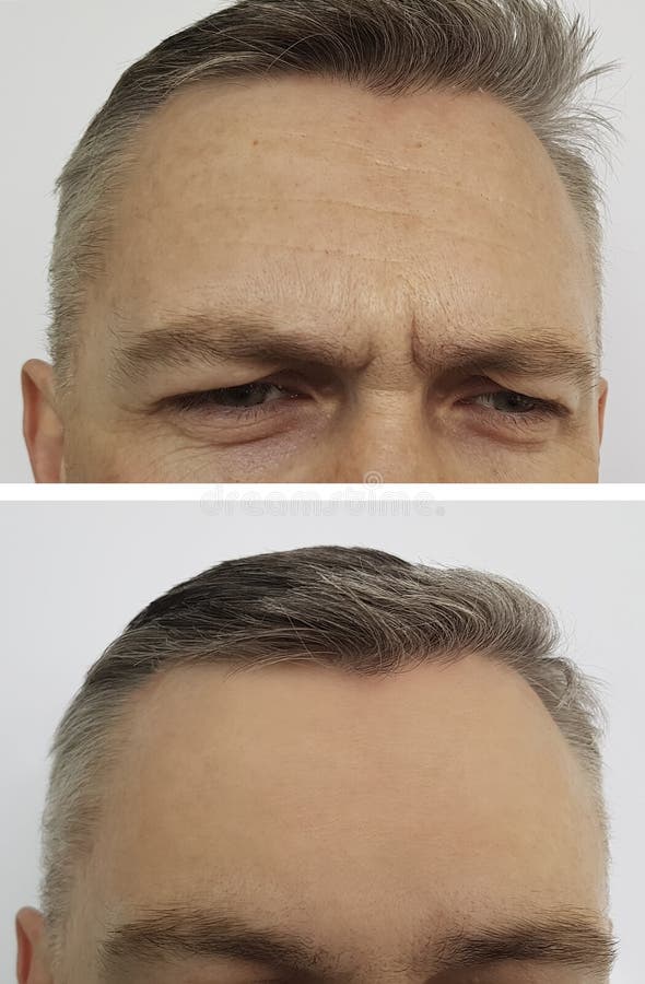 Man Wrinkles on the Forehead before and after Botox Stock Image - Image ...