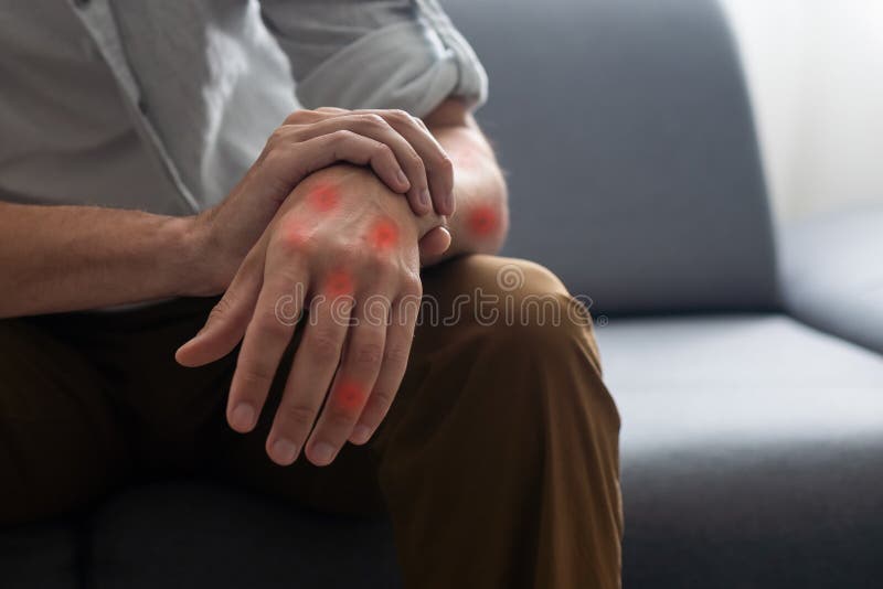 Manchas rojas en las manos foto de archivo. Imagen de gente - 261319848