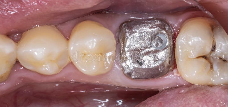 Restored Molars Stock Photos - Free & Royalty-Free Stock Photos from ...