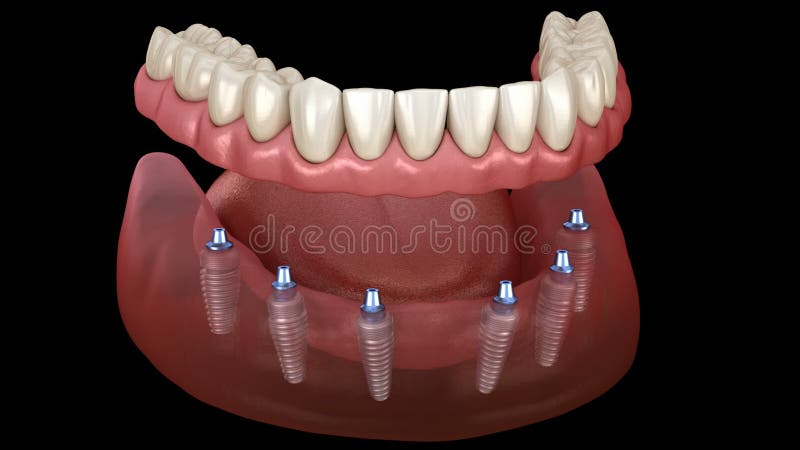 Mandibular Prosthesis All on 4 System Supported by Implants. Medically ...