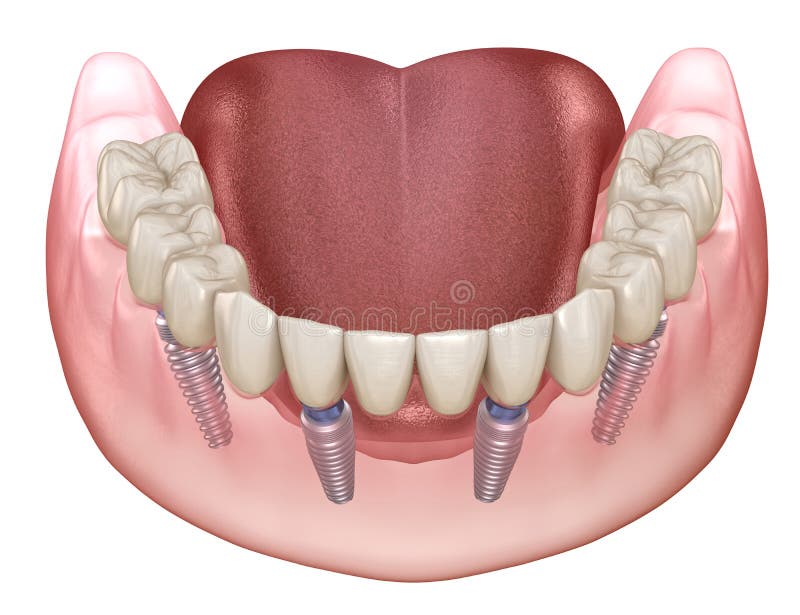 Mandibular Prosthesis All on 4 System Supported by Implants. Medically ...