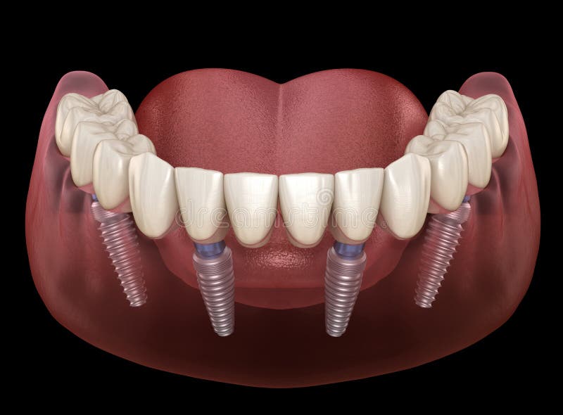 Mandibular Prosthesis All on 4 System Supported by Implants. Medically ...