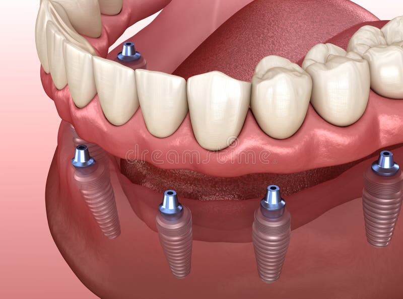 Mandibular Prosthesis with Gum All on 6 System Supported by Implants ...