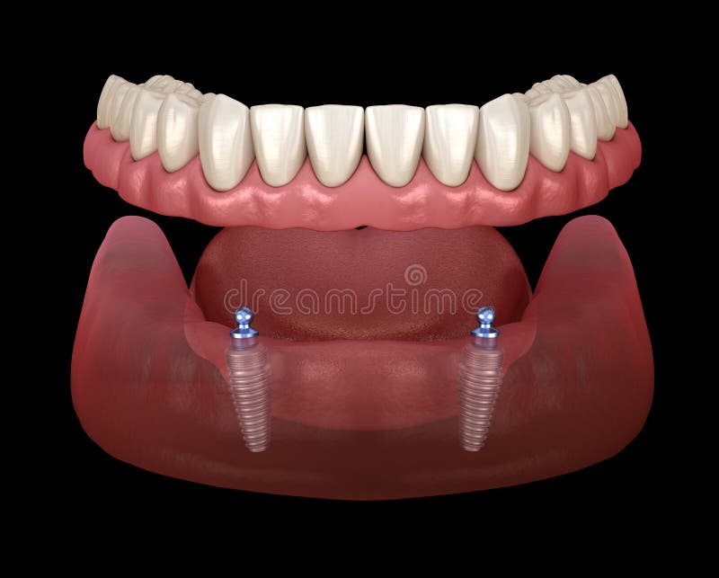 Mandibular Removable Prosthesis All on 2 System Supported by Implants ...