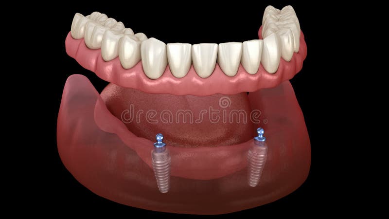 Mandibular Prosthesis All on 4 System Supported by Implants. Medically ...