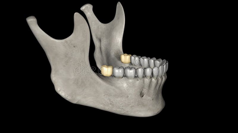 The Mandibular Third Molar is Also Referred As the Wisdom Tooth Stock ...