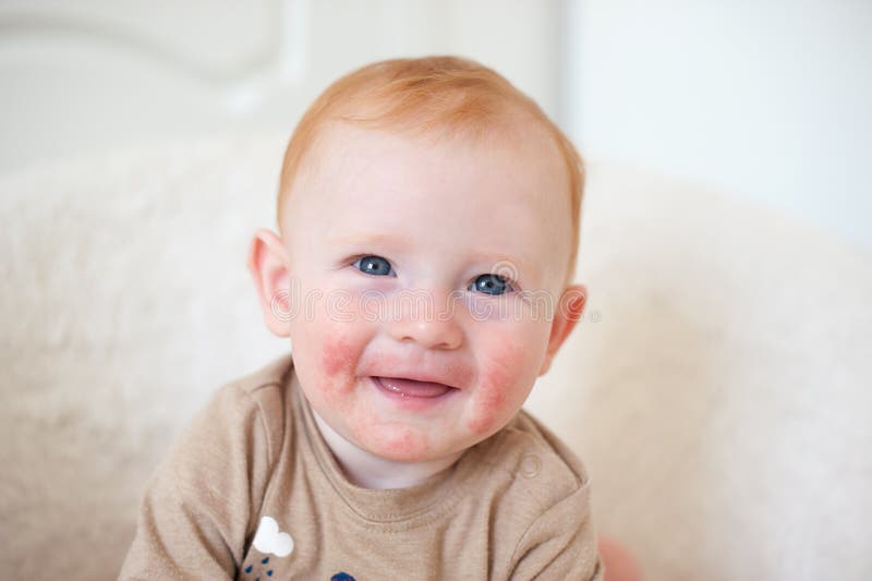 Le Visage D'un Enfant Avec Une Allergie Photo stock - Image of enfant ...