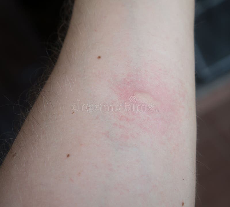 Morso di insetto immagine stock. Immagine di sfondo, irritante - 17255485