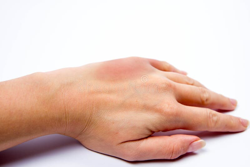 Mano contusionada foto de archivo. Imagen de delincuente - 52500818