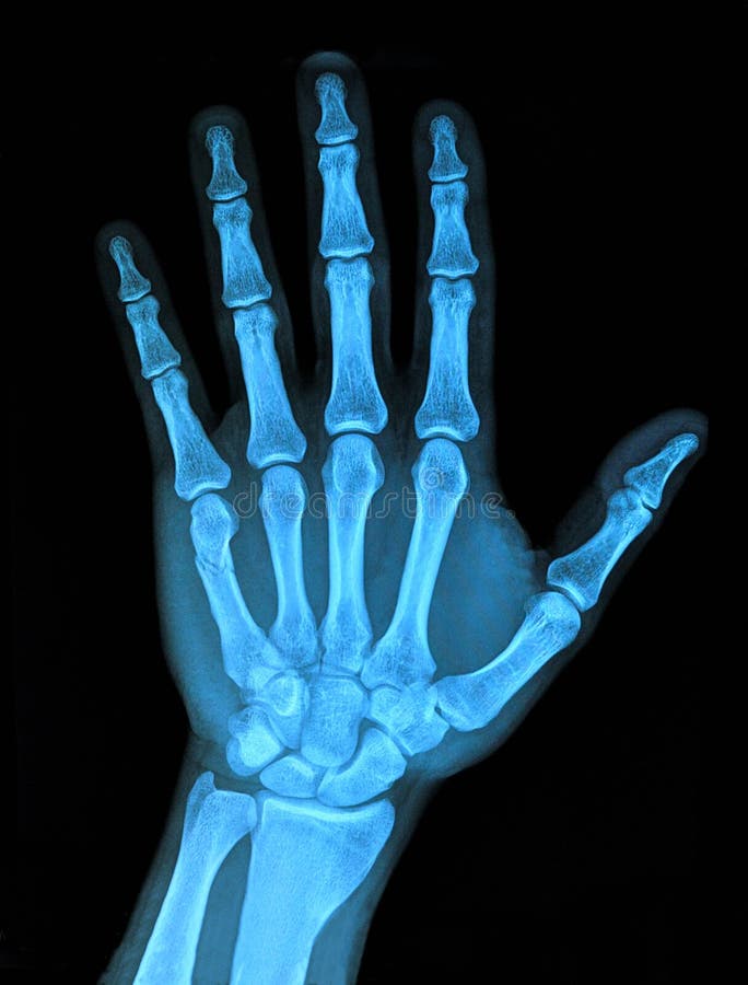 Radiografia della mano immagine stock. Immagine di cuore - 30365101