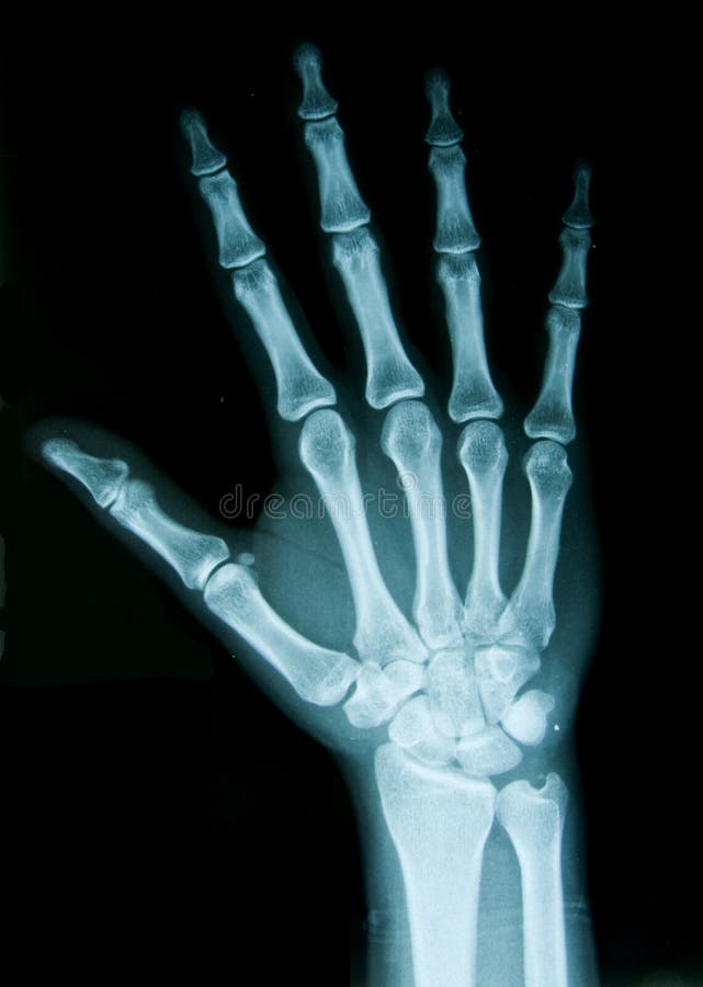 Mano dei raggi X immagine stock. Immagine di medico, raggio - 5216121