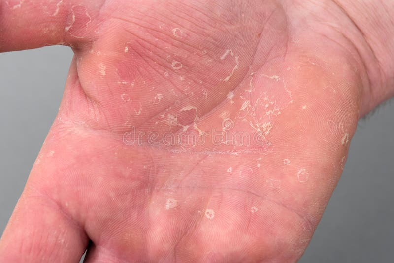 Mano Seca Con Piel Despegada. Dermatitis Eczema. Foto de archivo ...