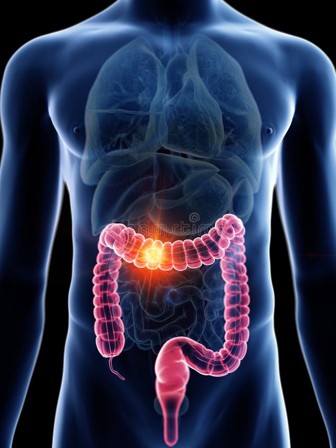 Koloncancer stock illustrationer. Illustration av diticulit - 155236571