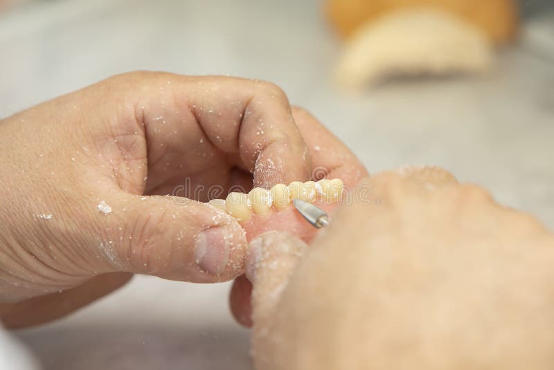 Orthopedist`s Hands Make Jaw Prostheses Stock Image - Image of medicine ...