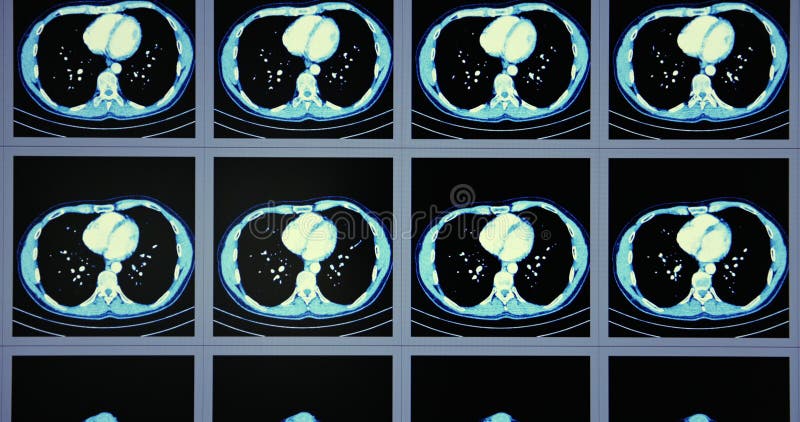 Many Computed Tomography Scans in Motion of Lower and Middle Abdominal ...