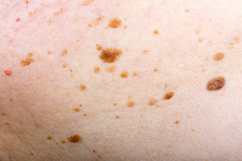 Nevus on the Skin. Melanoma or Cancer. Dermatology Stock Image - Image ...