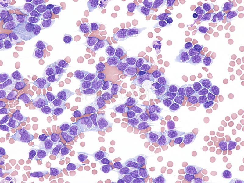 Marginal Zone Lymphoma in Bone Marrow. Cytology. Stock Photo - Image of ...