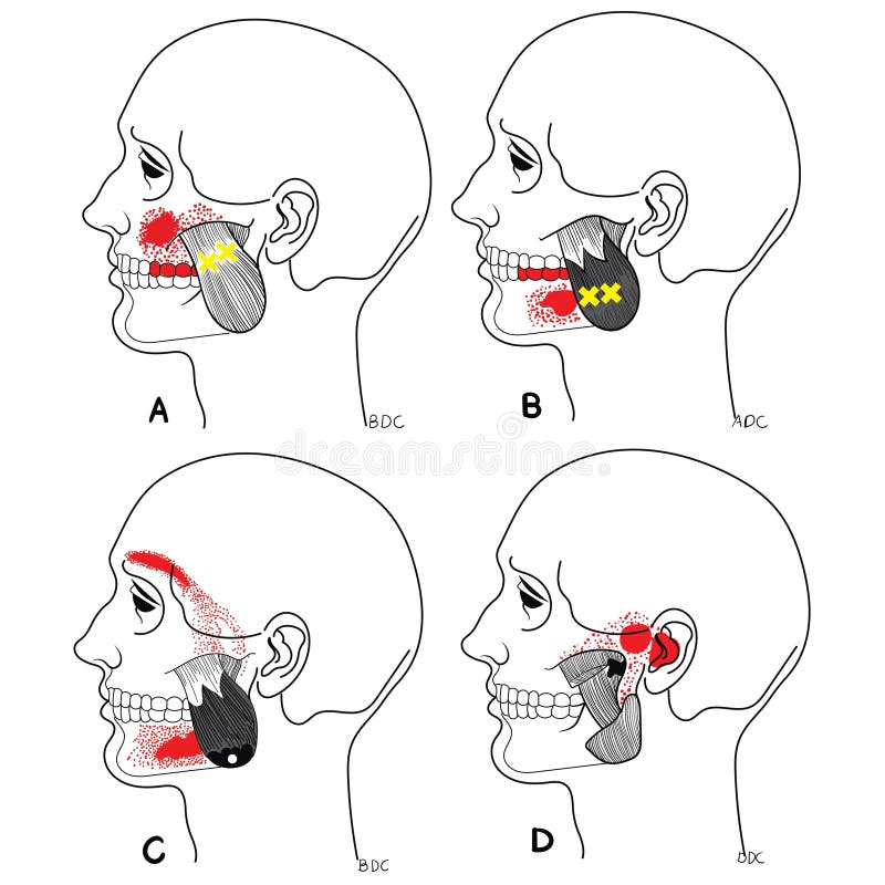 Four Masetero Trigger Points Vector Diagram Stock Vector - Illustration ...