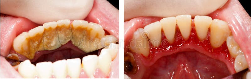 Massive Tartar and Treatment Stock Photo - Image of cavity, mouth: 29699150