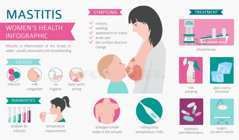 Mastitis Breastfeed Medical Infographic Diagnostics Symptoms Stock